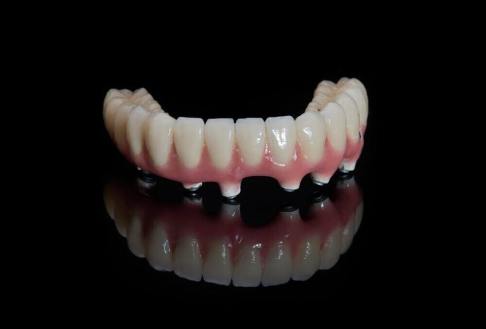 Implants | Tyler, TX | Creative Dental Lab